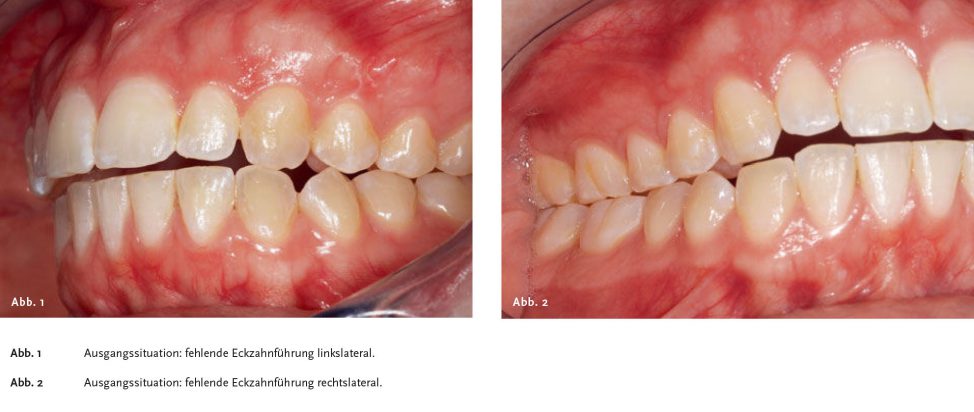 Die Wiederherstellung der Eckzahnführung - Dr. Sielemann