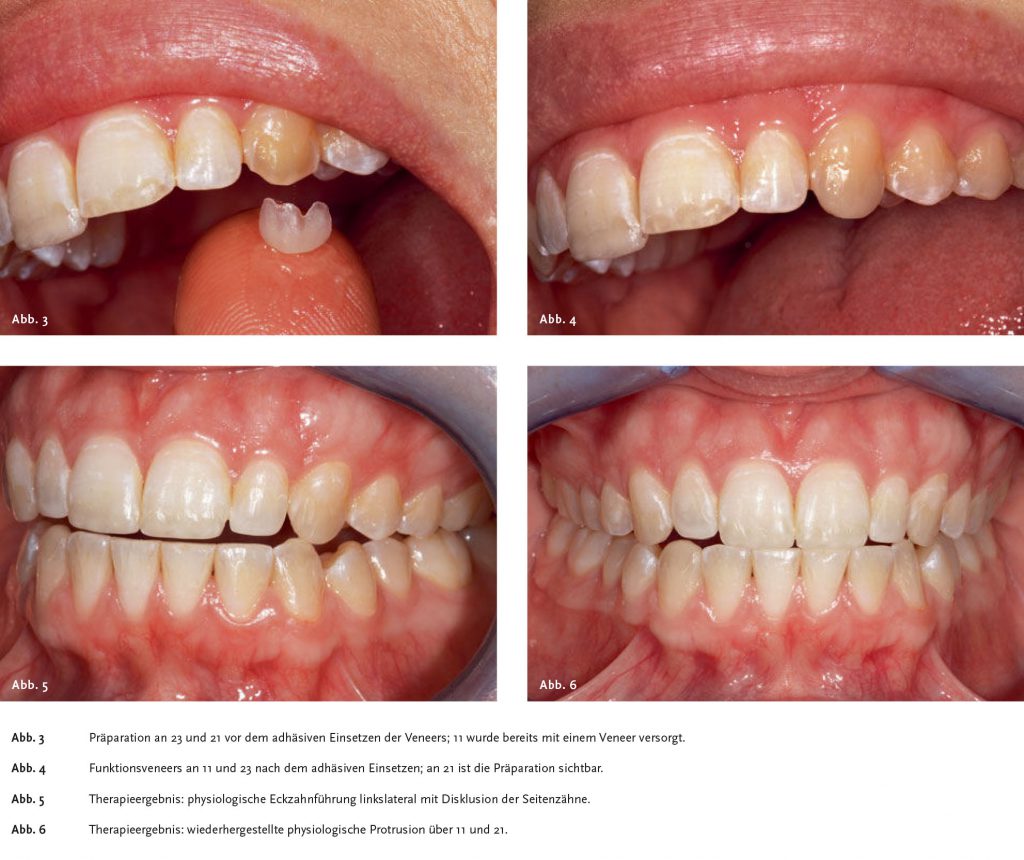 Die Wiederherstellung der Eckzahnführung - Dr. Sielemann